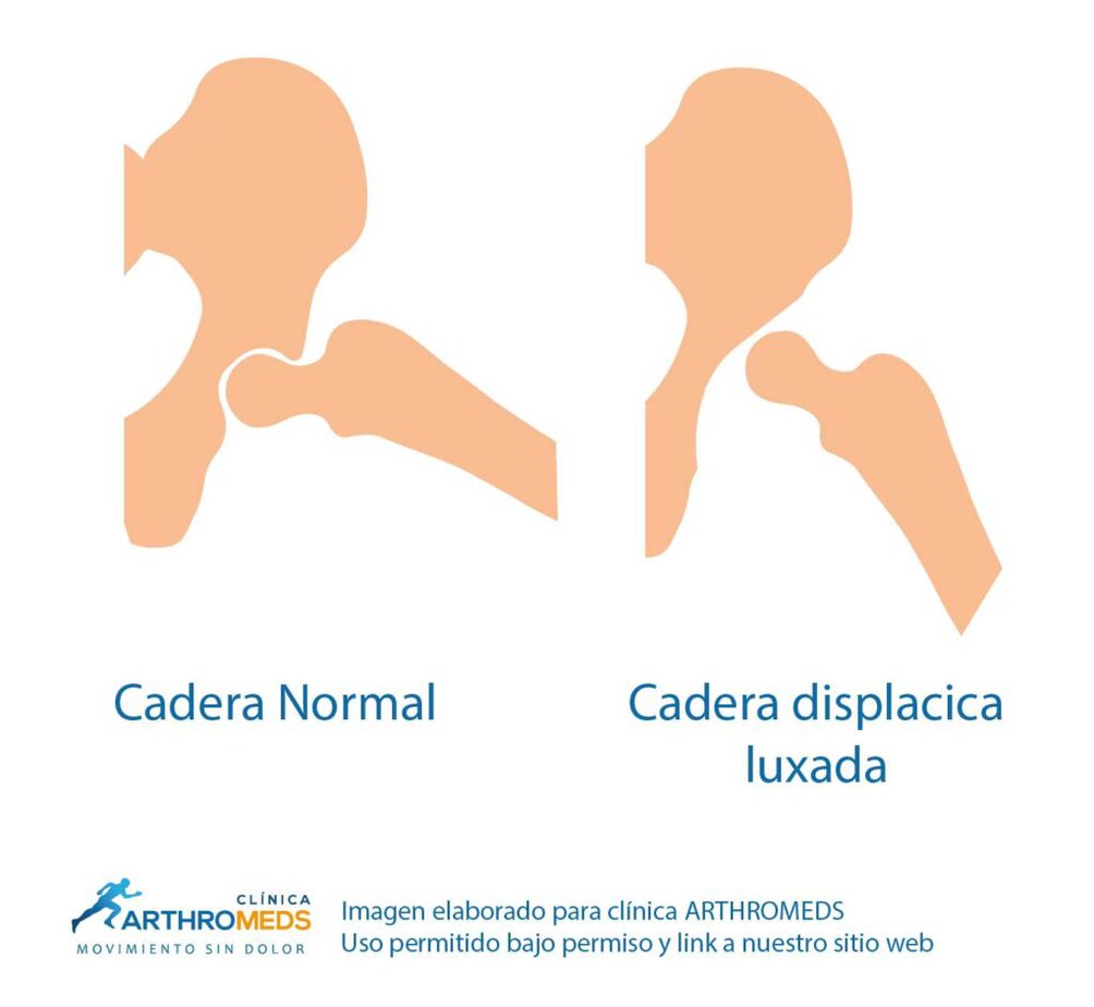 Cirugía para corregir luxación congenita de cadera