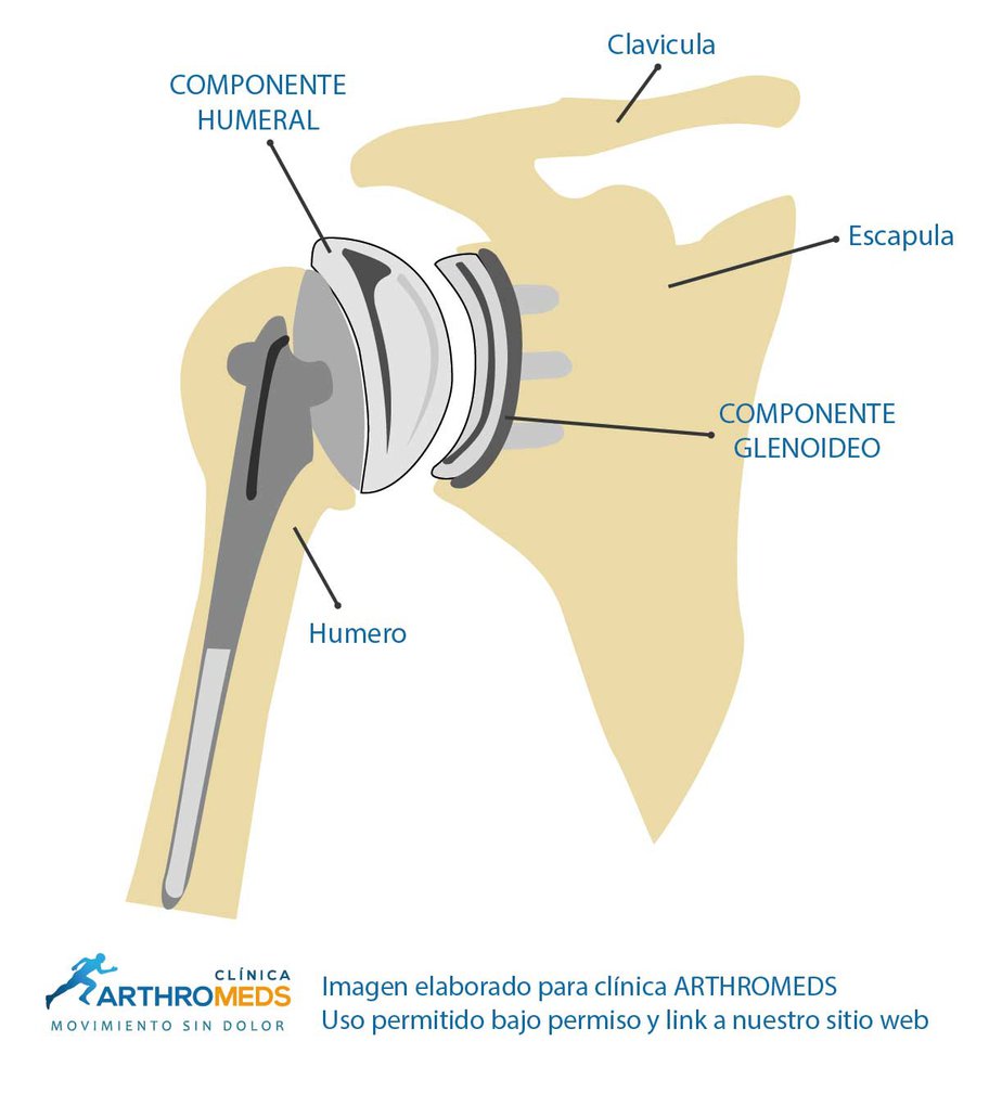 Cirugía de prótesis de hombro por artrosis - artroplastia Lima Perú
