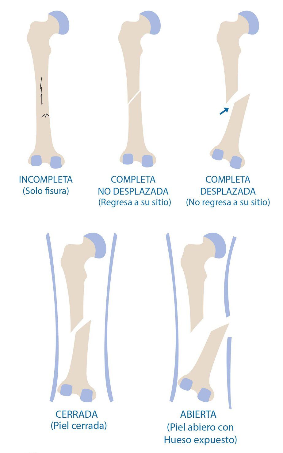 Qu Tratamientos Existen Para Las Fracturas Traumatologa Y