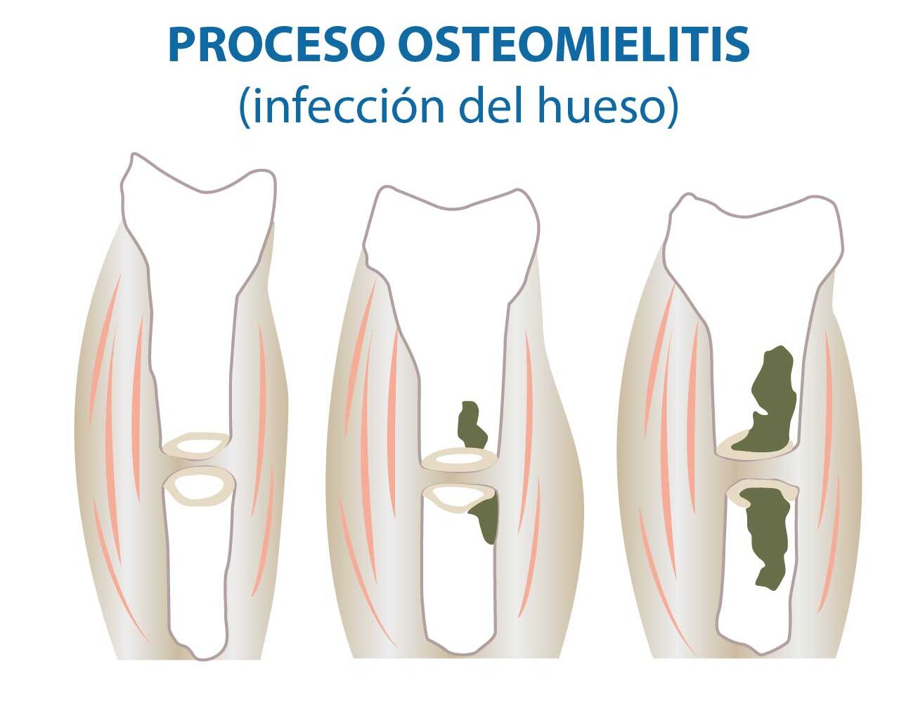 Especialistas En Osteomielitis Lima Perú